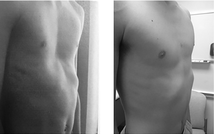 Pectus Excavatum vs Carinatum